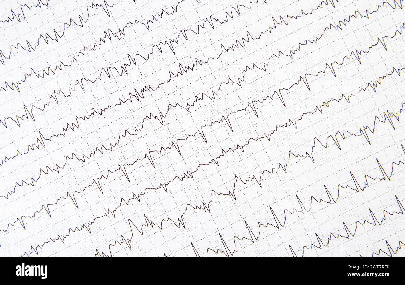 A graphic EKG electrocardiogram of a person with heart disease Stock ...