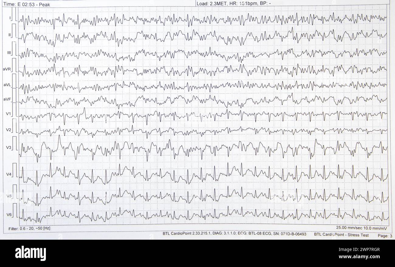 A graphic EKG electrocardiogram of a person with heart disease Stock ...