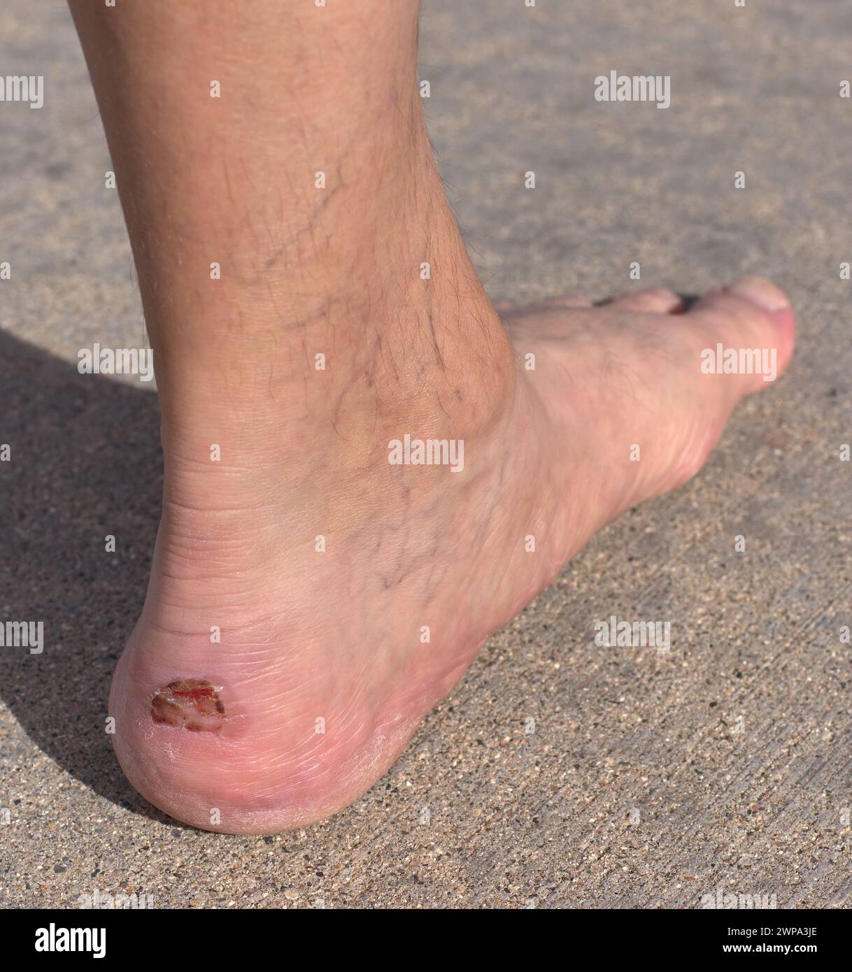 Left human foot with an injury to the back of the heel due to ...