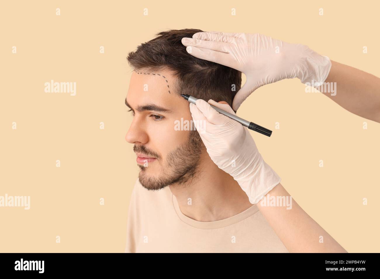 Doctor marking young man's forehead with hair loss problem on beige ...
