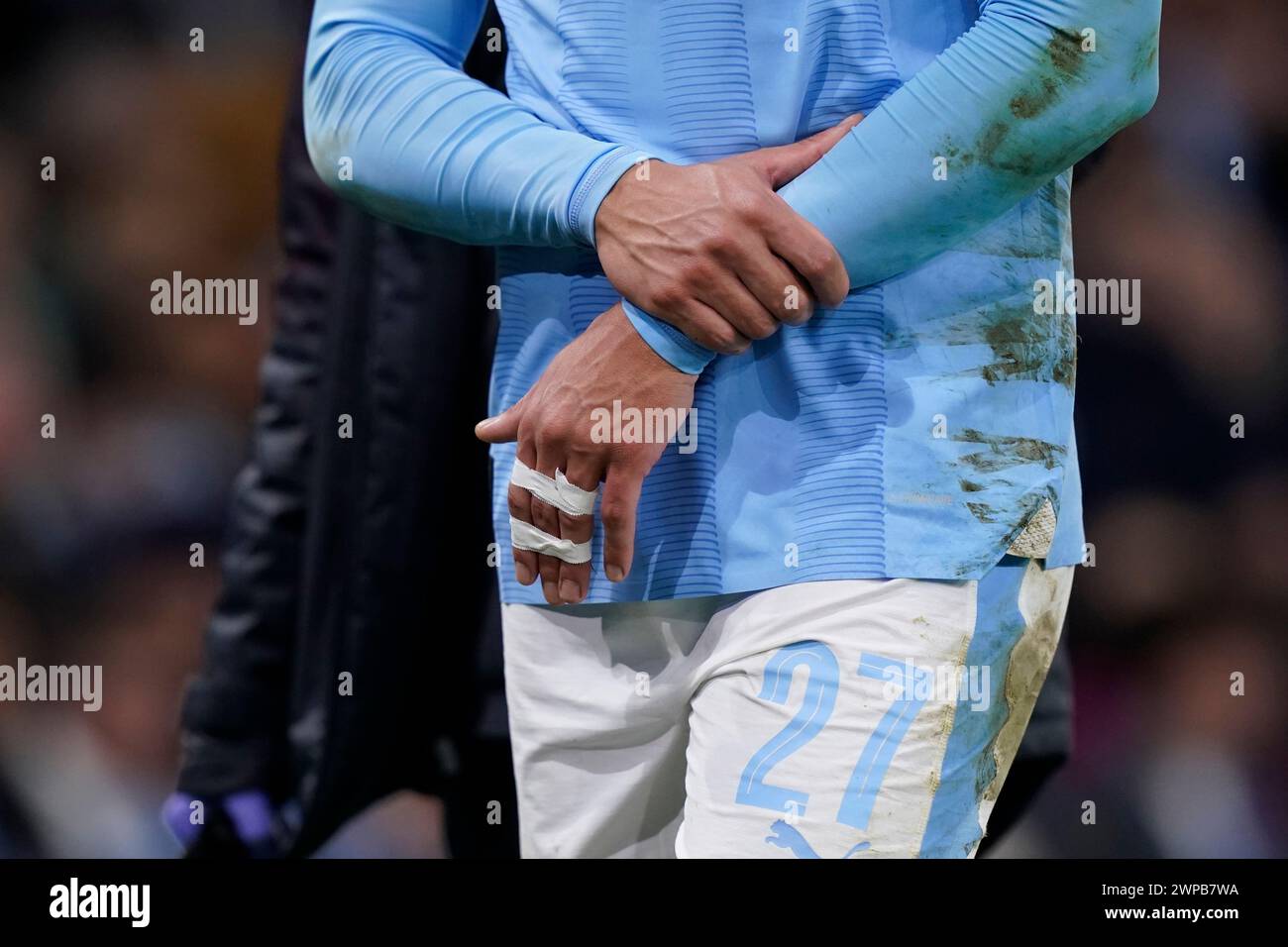 Dislocated finger hi-res stock photography and images - Alamy