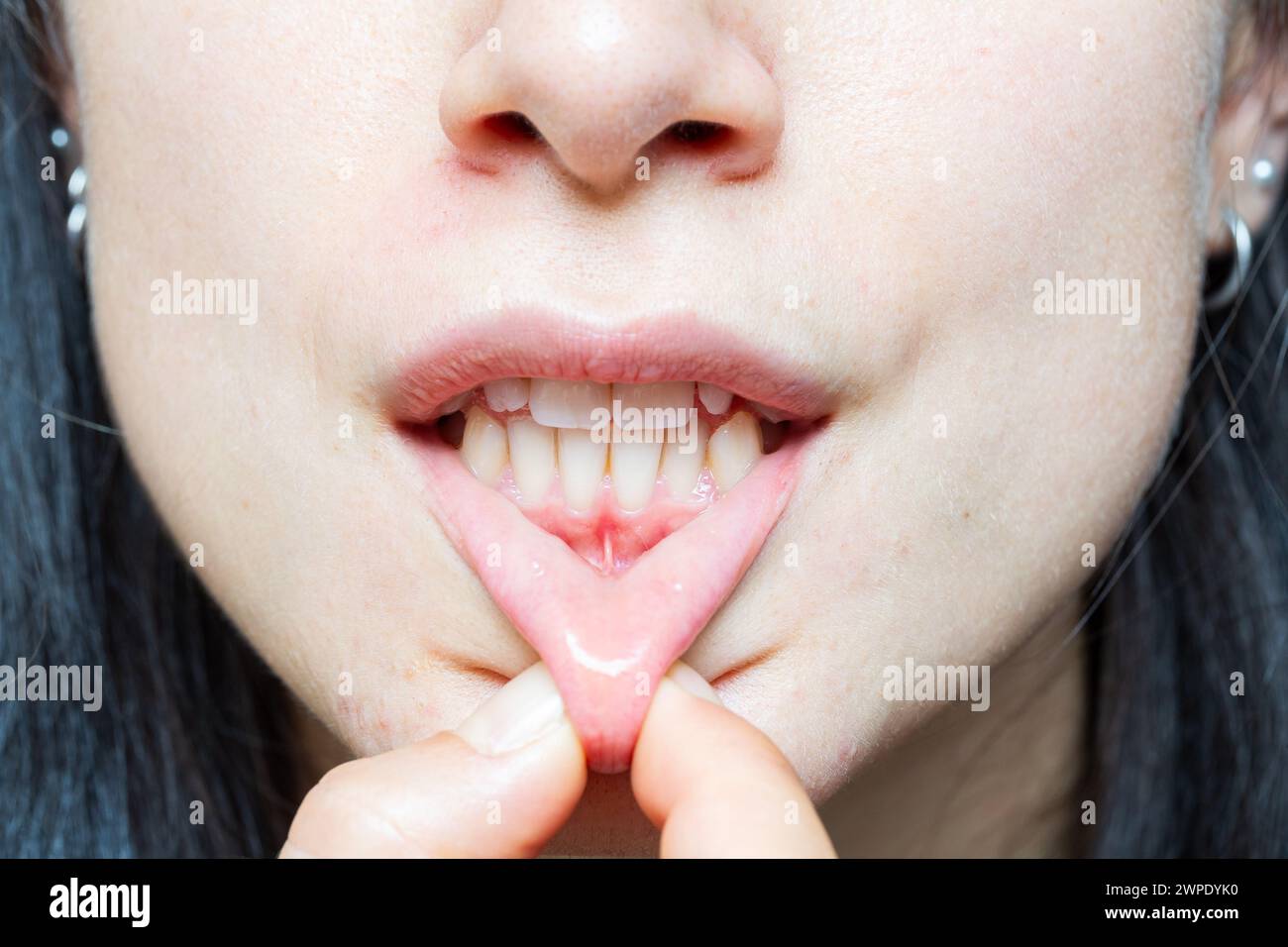 Teeth erosion hi-res stock photography and images - Alamy