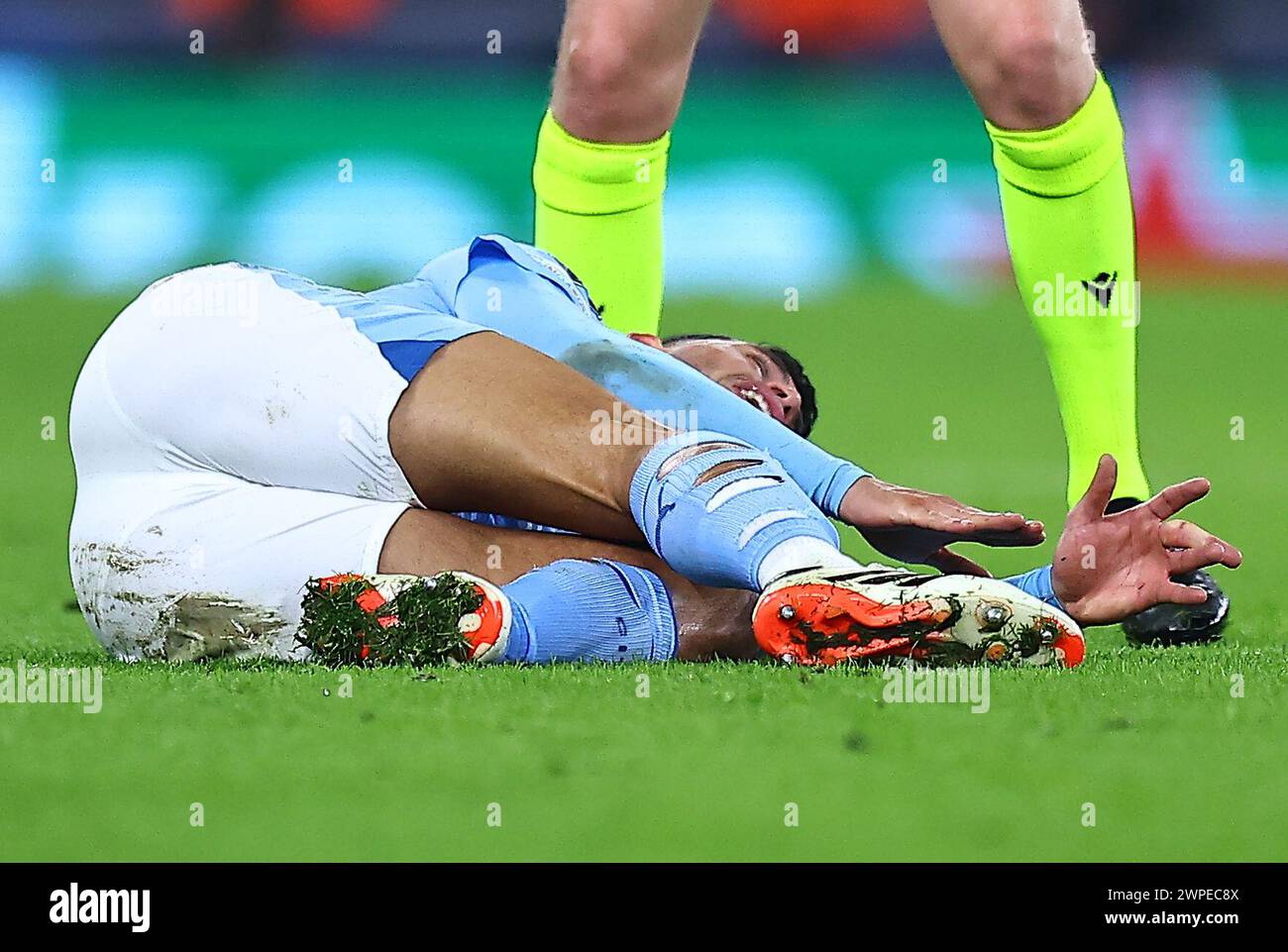 Dislocated finger hi-res stock photography and images - Alamy