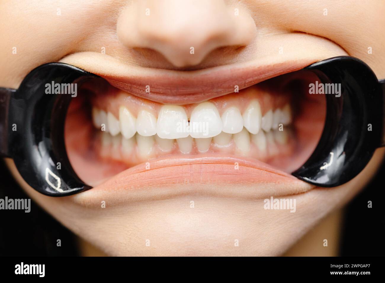 Close up of woman cavity protected by retractor showing perfect teeth ...