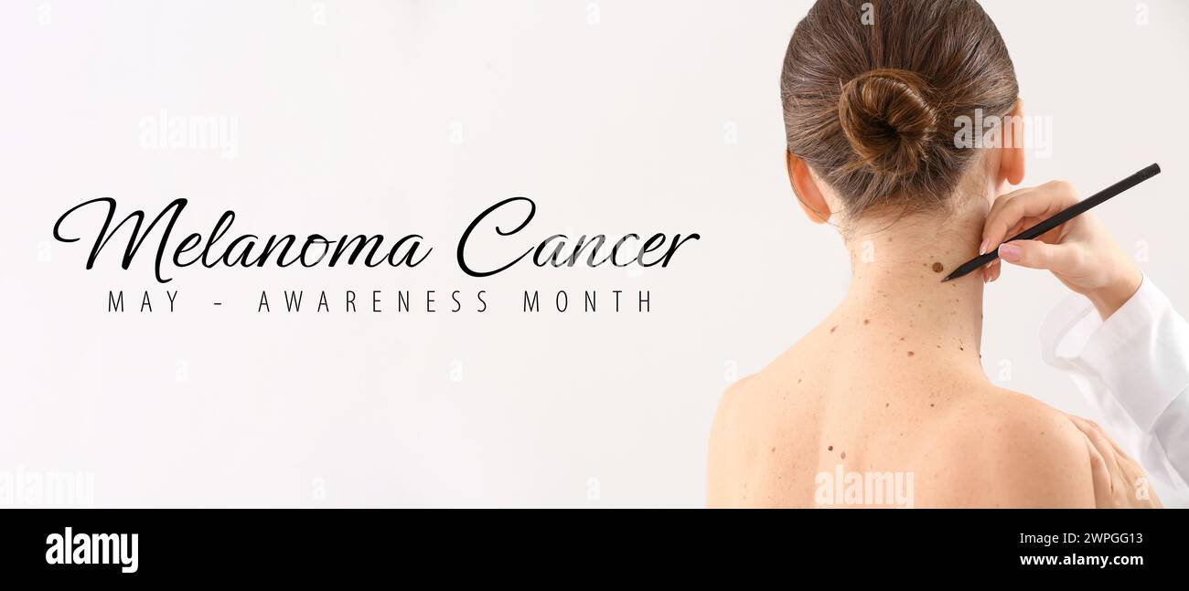 Dermatologist applying marks onto patient's skin before moles removal ...