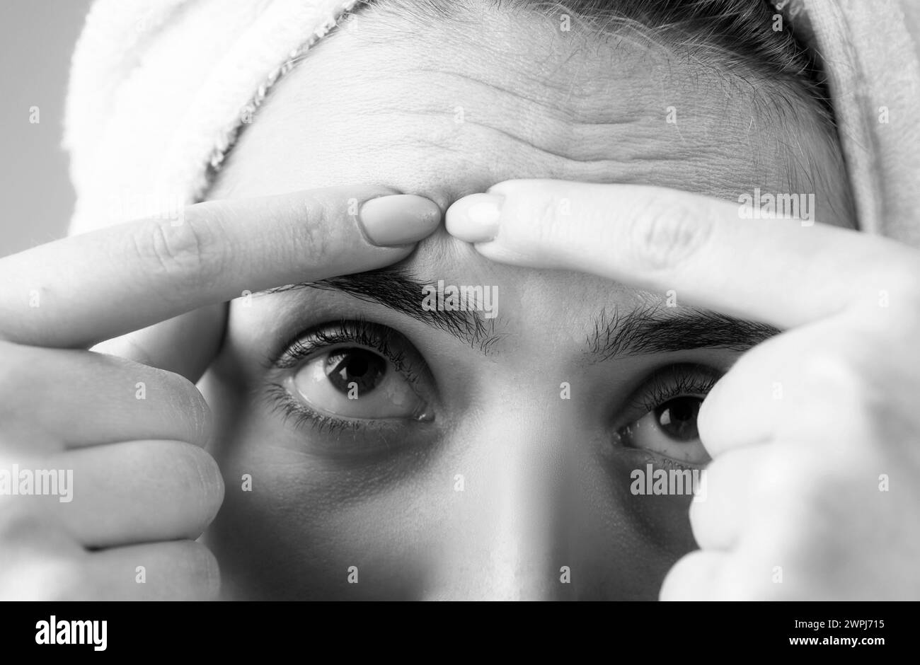 Facial skin pimples acne Black and White Stock Photos & Images - Alamy