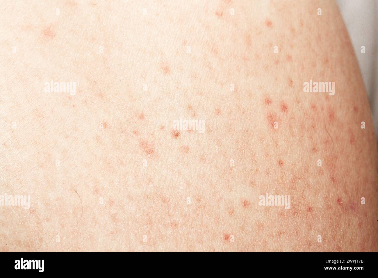 Itchy skin rash hi-res stock photography and images - Alamy