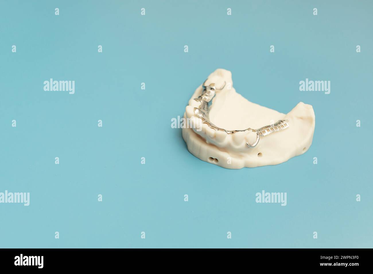 Mockup Metal Frame Lower Partial Denture On Die Stone, Plaster Cast ...