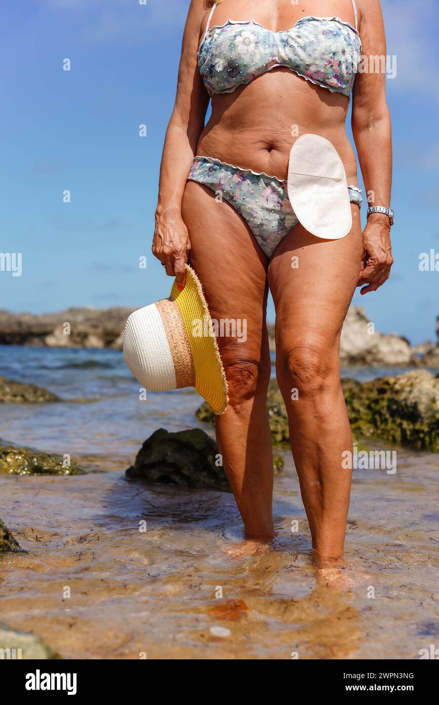 Unrecognizable Woman With A Colostomy Bag After Of An Colon Cancer 7349