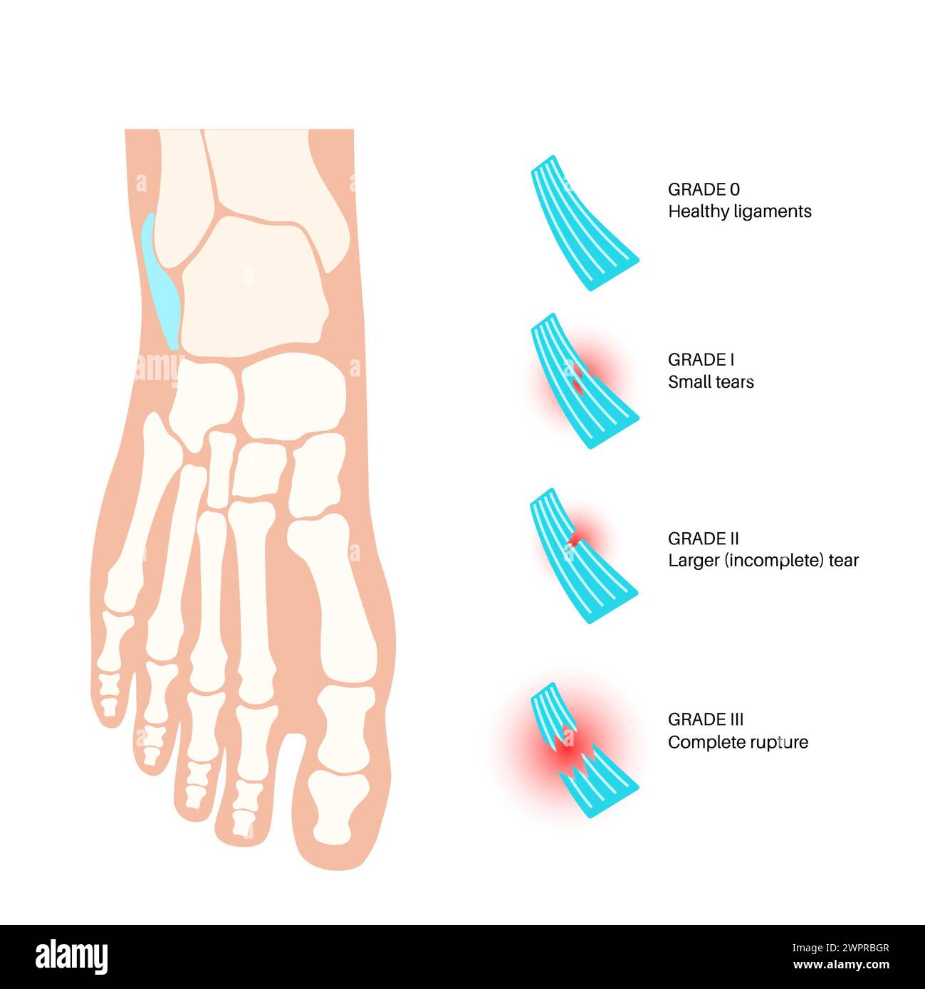 Ankle sprain injury, illustration Stock Photo - Alamy