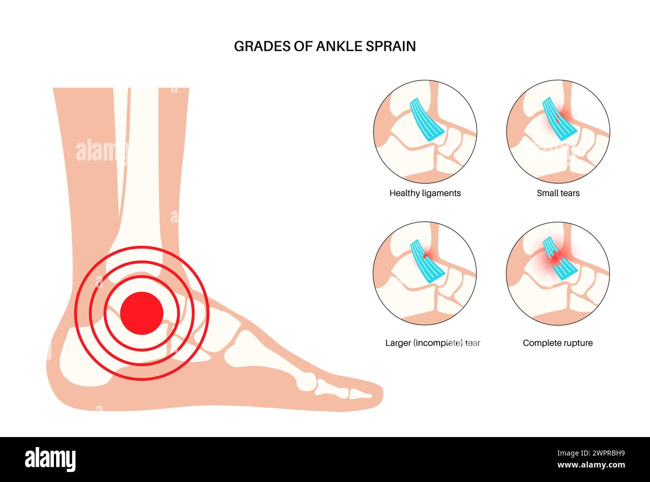 Ankle sprain injury, illustration Stock Photo - Alamy