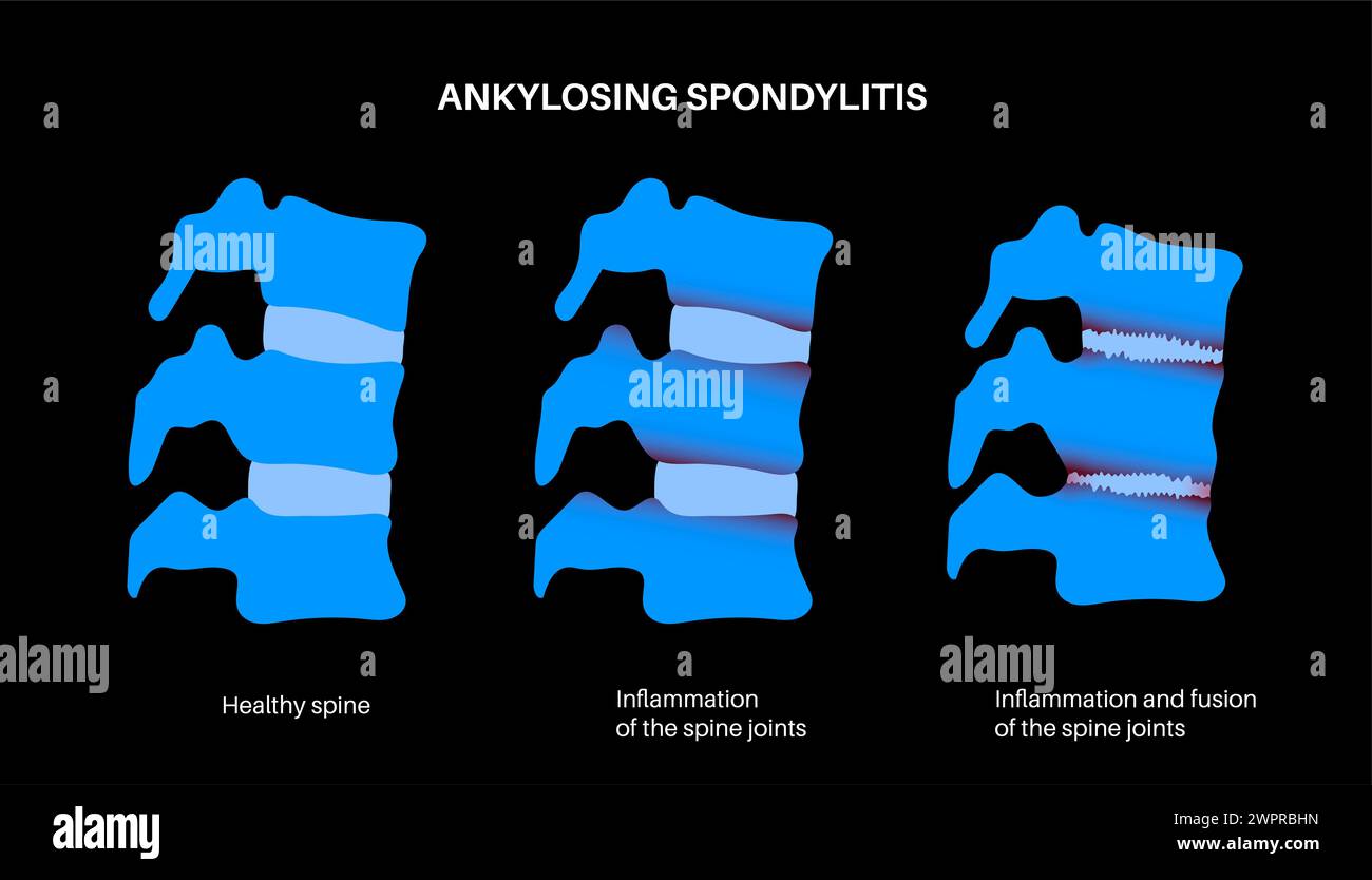 Imaging Of Axial Spondyloarthritis Including Ankylosing