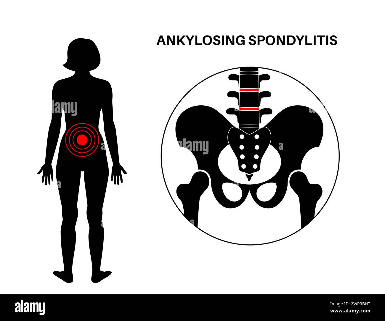 Ankylosing spondylitis, illustration Stock Photo - Alamy