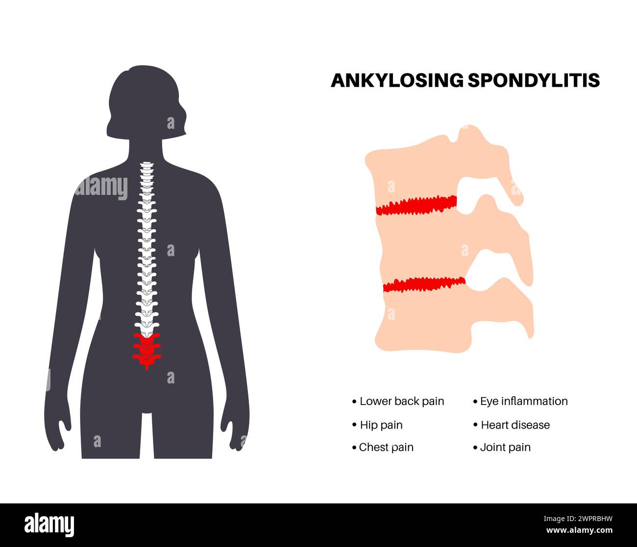 Ankylosing spondylitis, illustration Stock Photo - Alamy