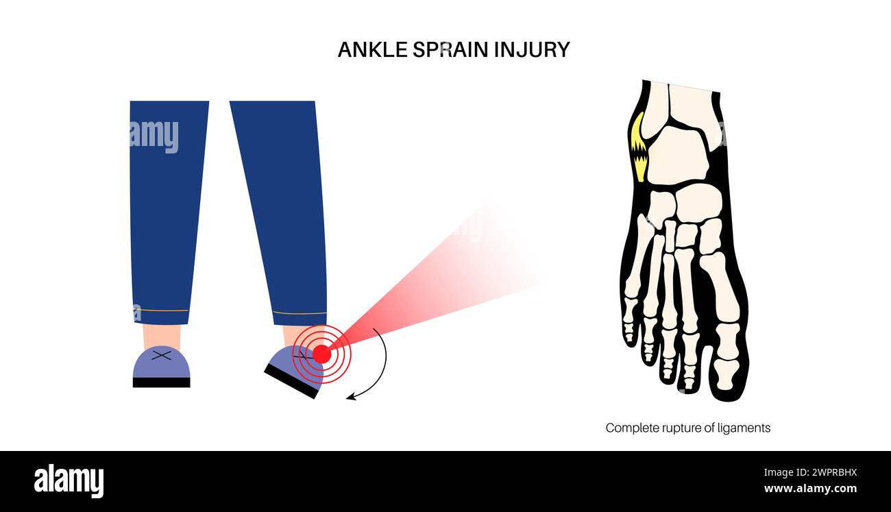 Ankle sprain injury, illustration Stock Photo - Alamy