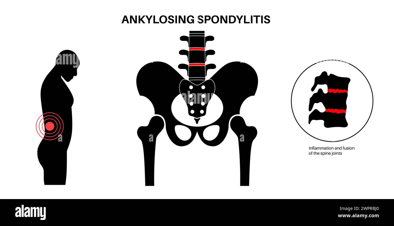 Cervical spondylitis hi-res stock photography and images - Alamy