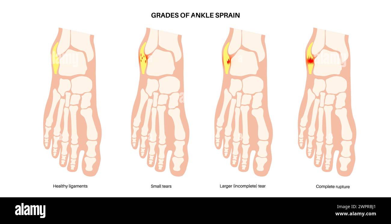 Ankle sprain injury, illustration Stock Photo - Alamy