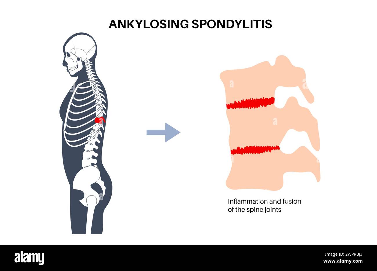 Ankylosing spondylitis, illustration Stock Photo - Alamy