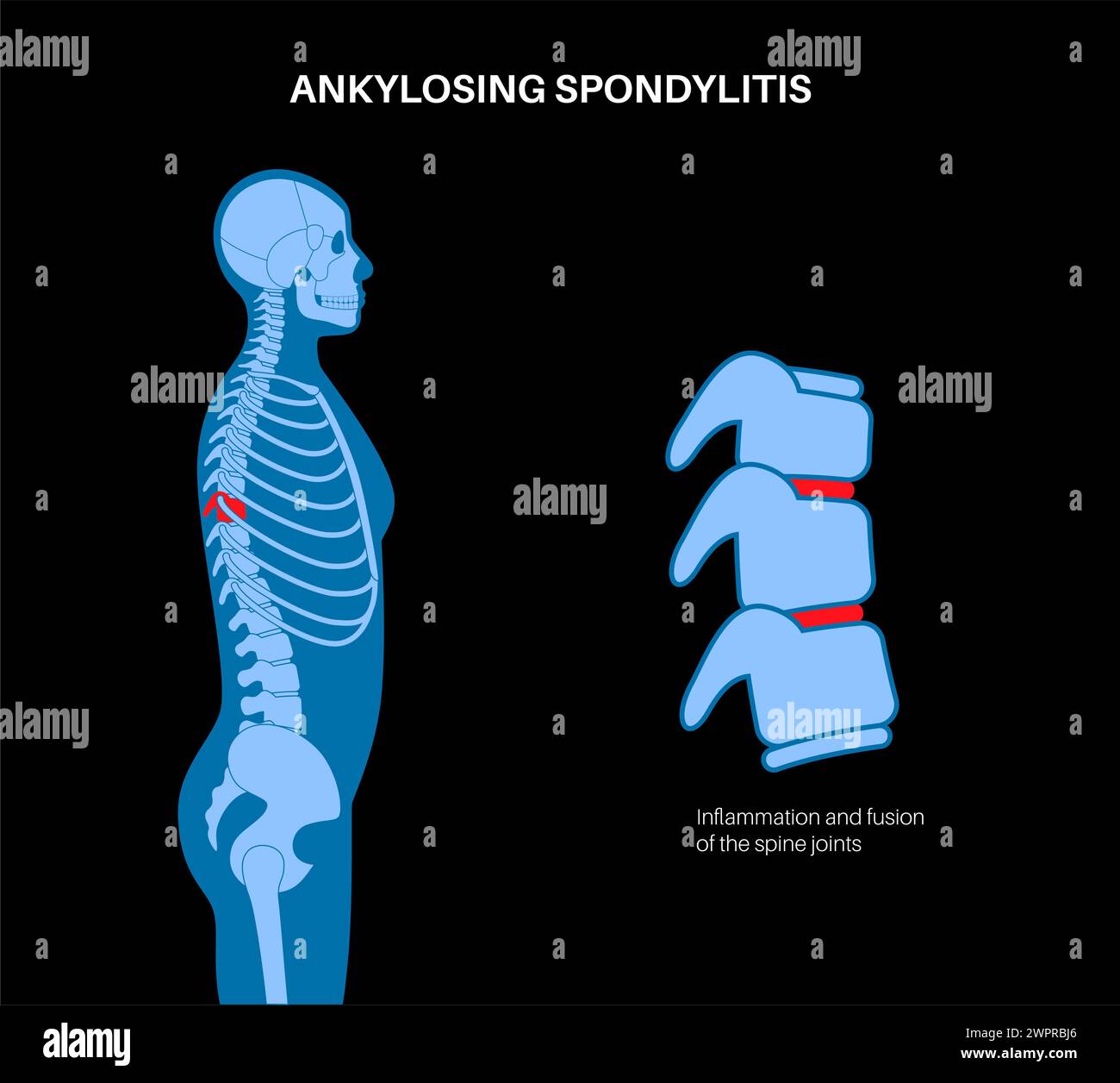Ankylosing spondylitis, illustration Stock Photo - Alamy
