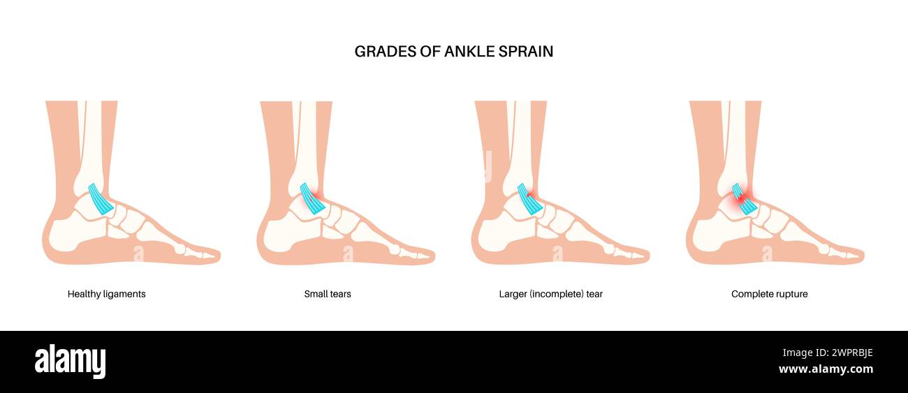 Ankle sprain injury, illustration Stock Photo - Alamy