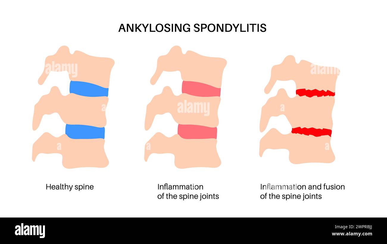 Ankylosing spondylitis, illustration Stock Photo - Alamy