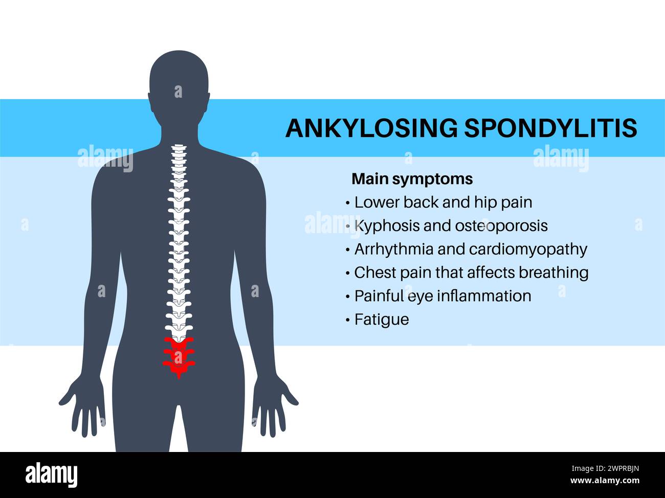 Ankylosing spondylitis, illustration Stock Photo - Alamy