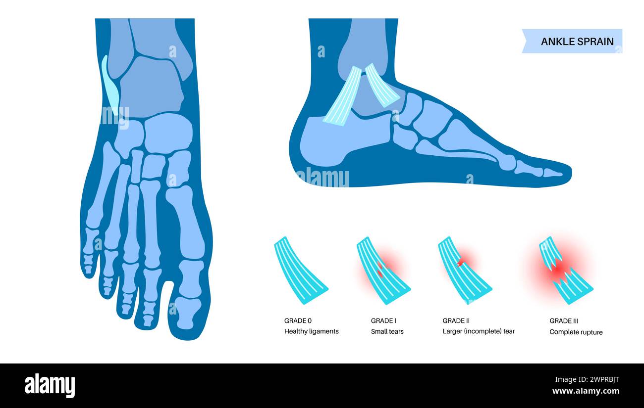 Ankle sprain injury, illustration Stock Photo - Alamy