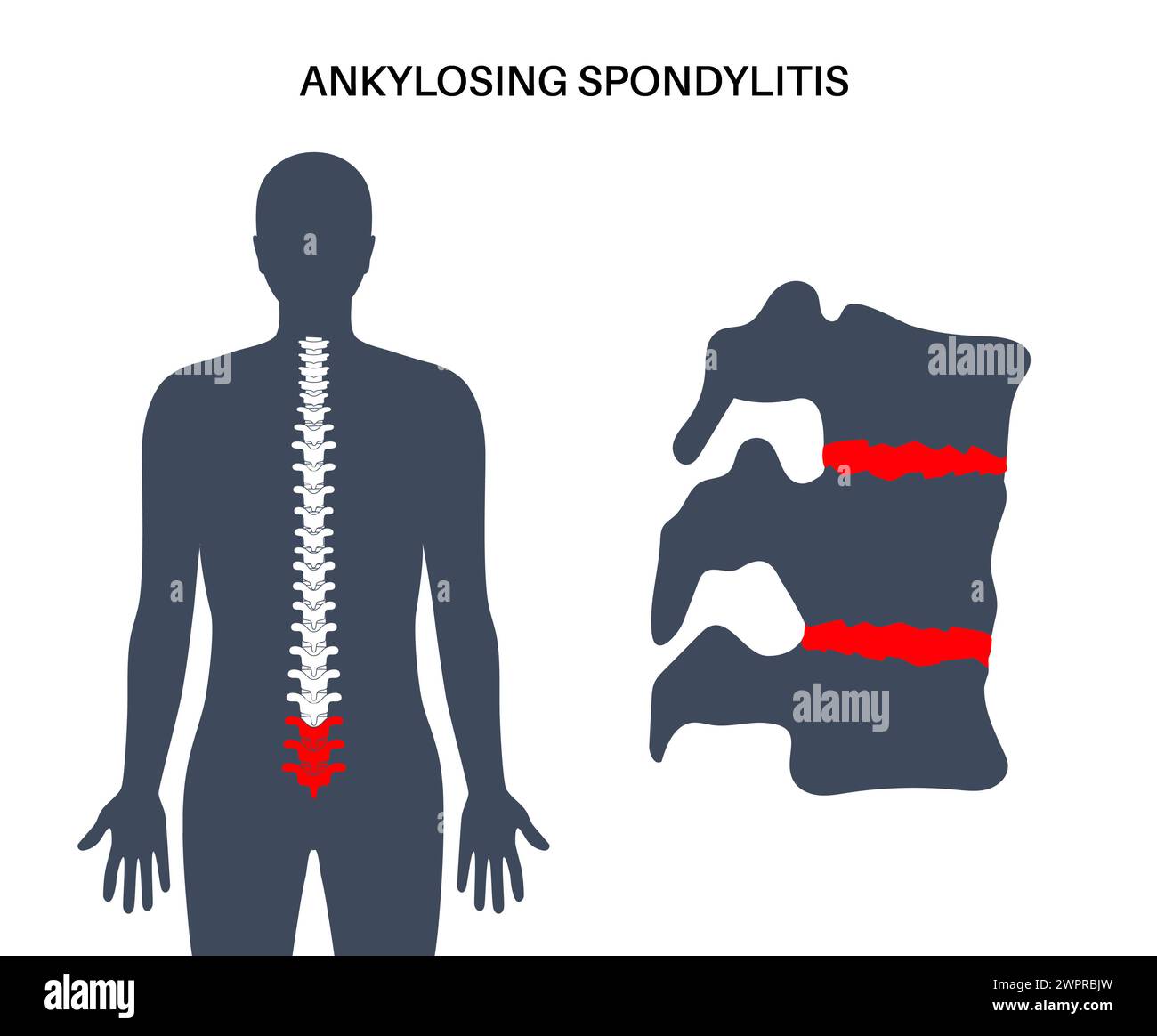 Herniated disc illustration hi-res stock photography and images - Alamy