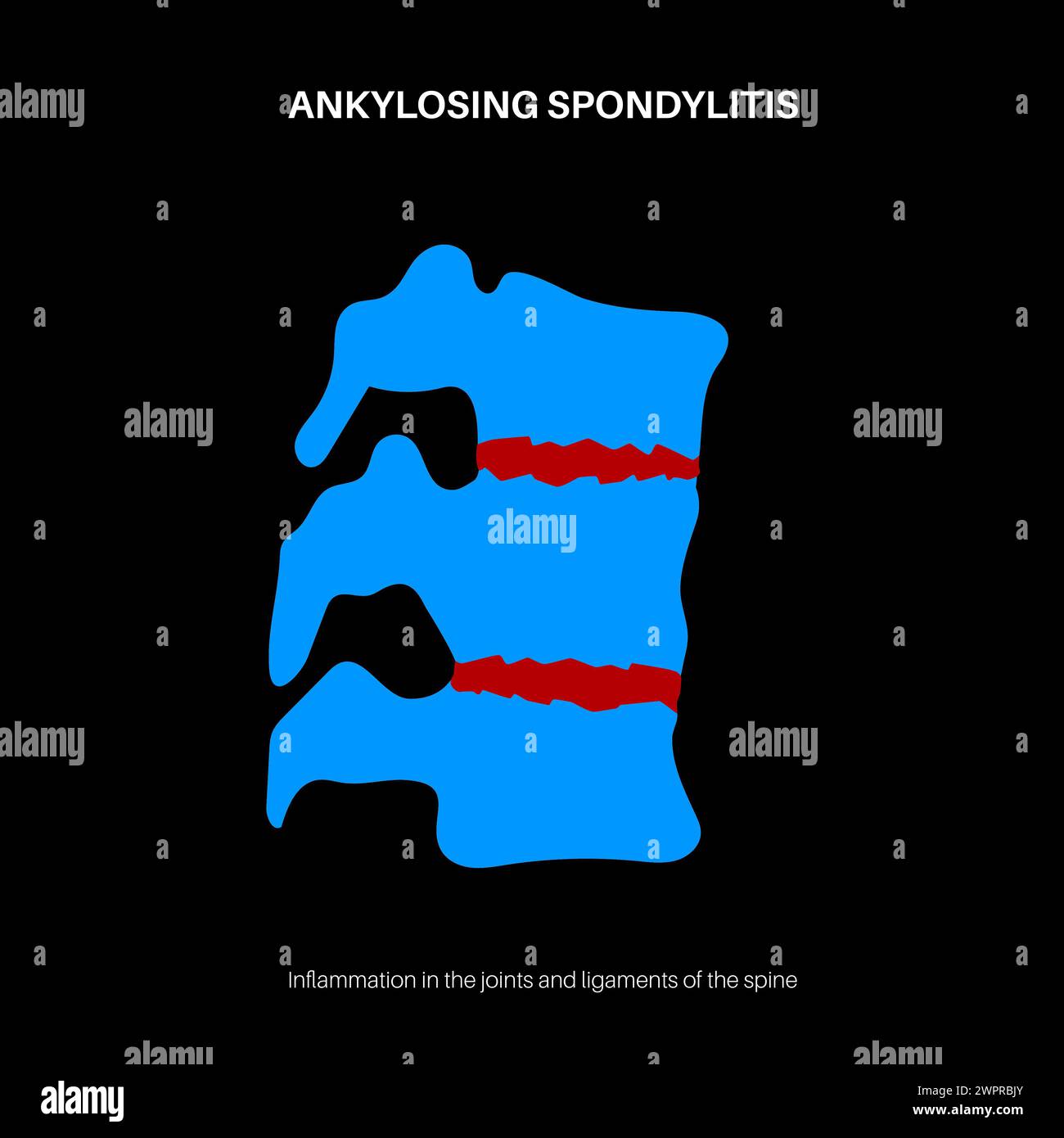 Ankylosing spondylitis, illustration Stock Photo - Alamy