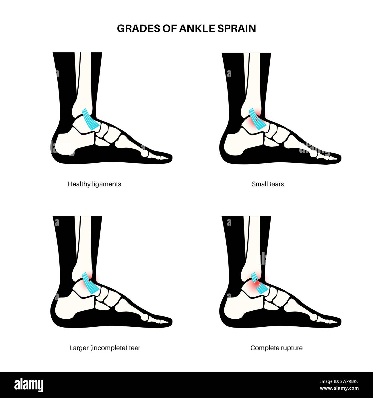 Ankle sprain injury, illustration Stock Photo - Alamy