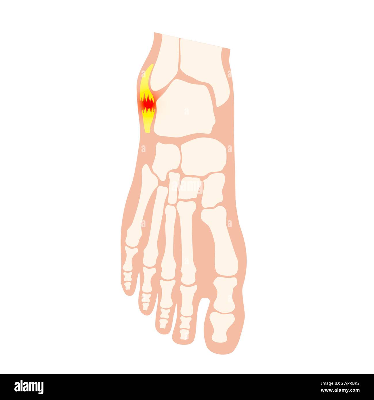 Ankle sprain injury, illustration Stock Photo - Alamy