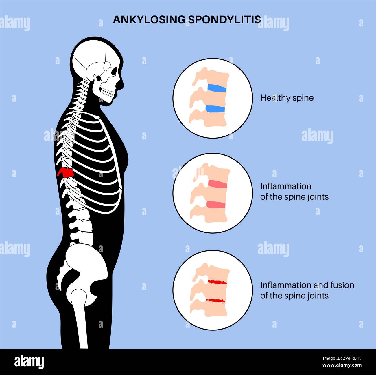 Ankylosing spondylitis, illustration Stock Photo - Alamy