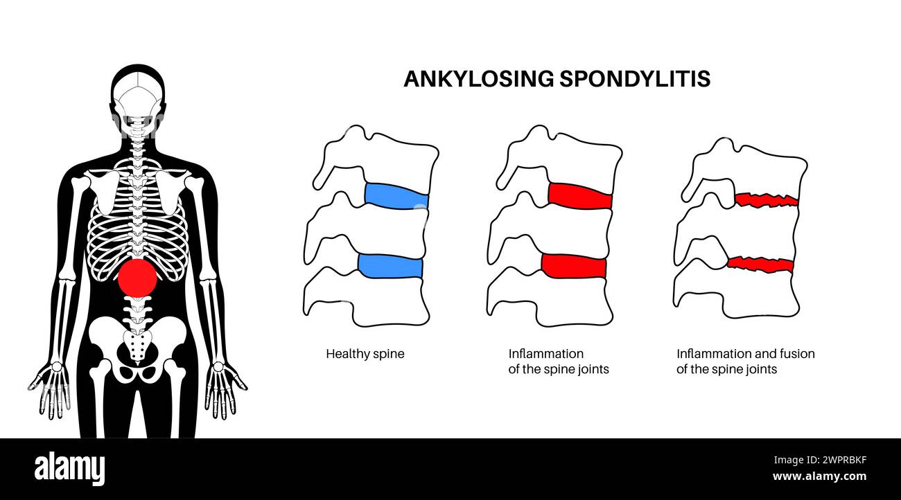 Ankylosing spondylitis, illustration Stock Photo - Alamy