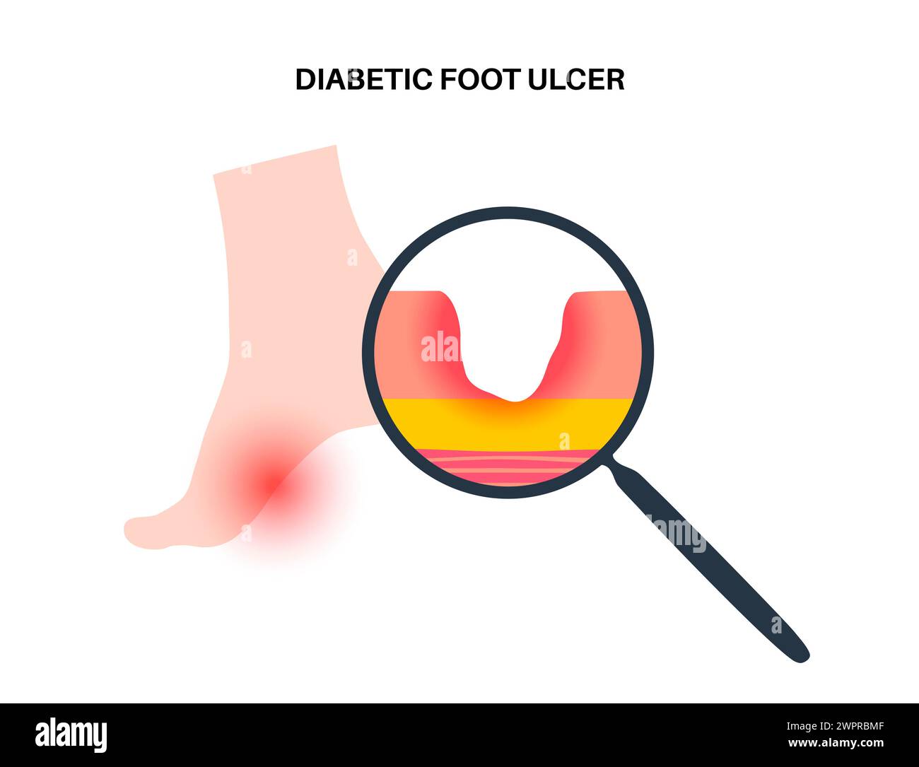 Diabetic foot ulcers, illustration Stock Photo - Alamy