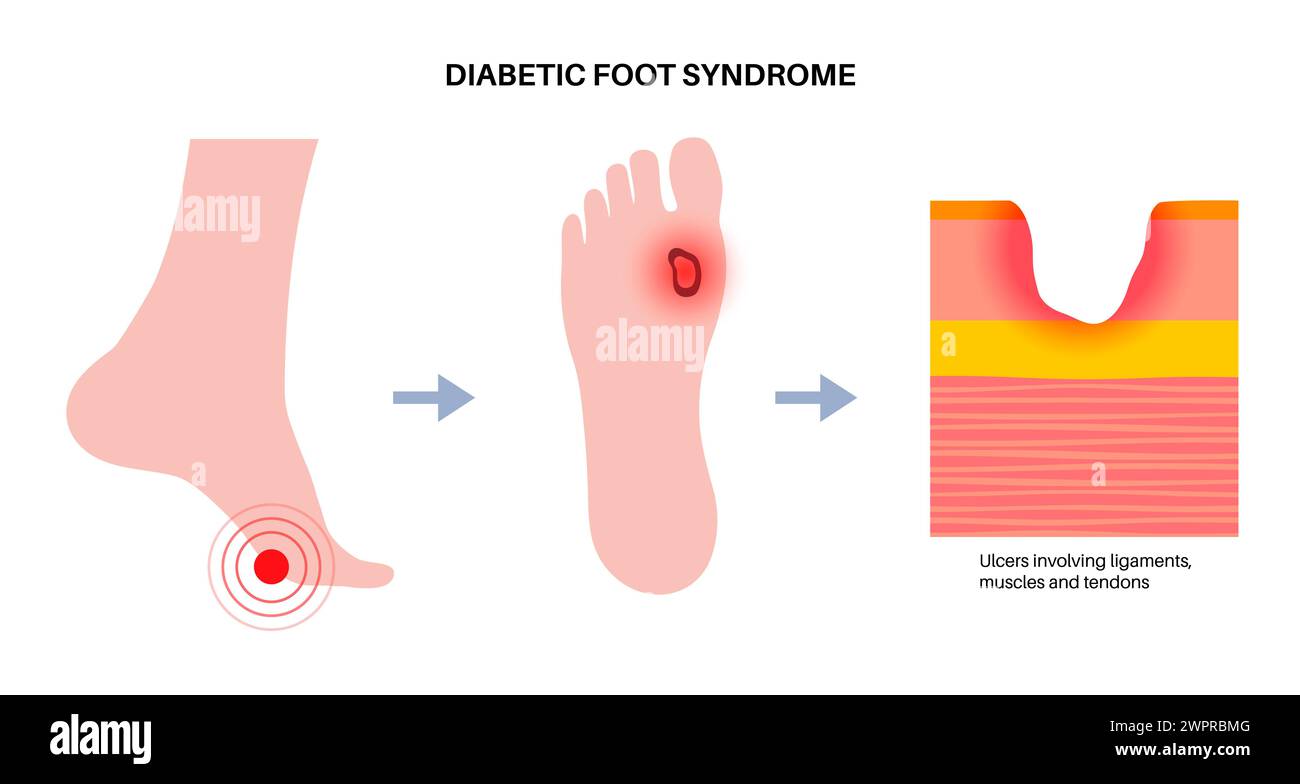 Diabetic foot ulcers, illustration Stock Photo - Alamy
