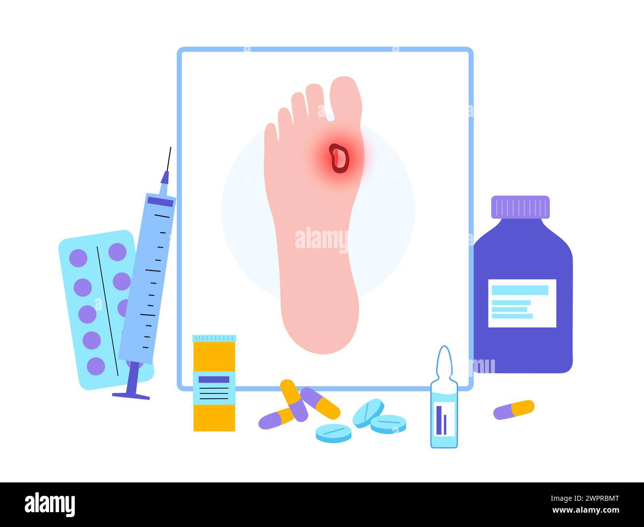 Diabetic foot ulcers, illustration Stock Photo - Alamy