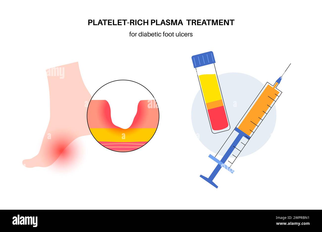 Diabetic foot syndrome treatment, illustration Stock Photo - Alamy