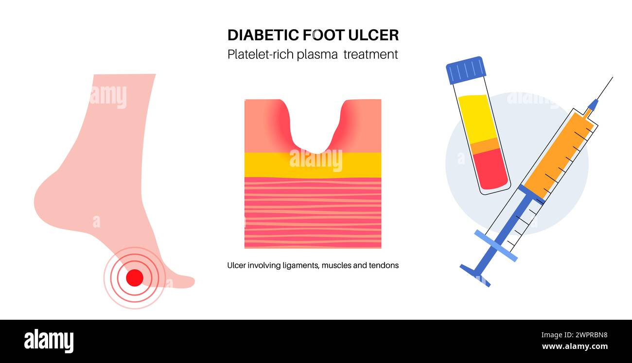 Diabetic foot ulcers, illustration Stock Photo - Alamy