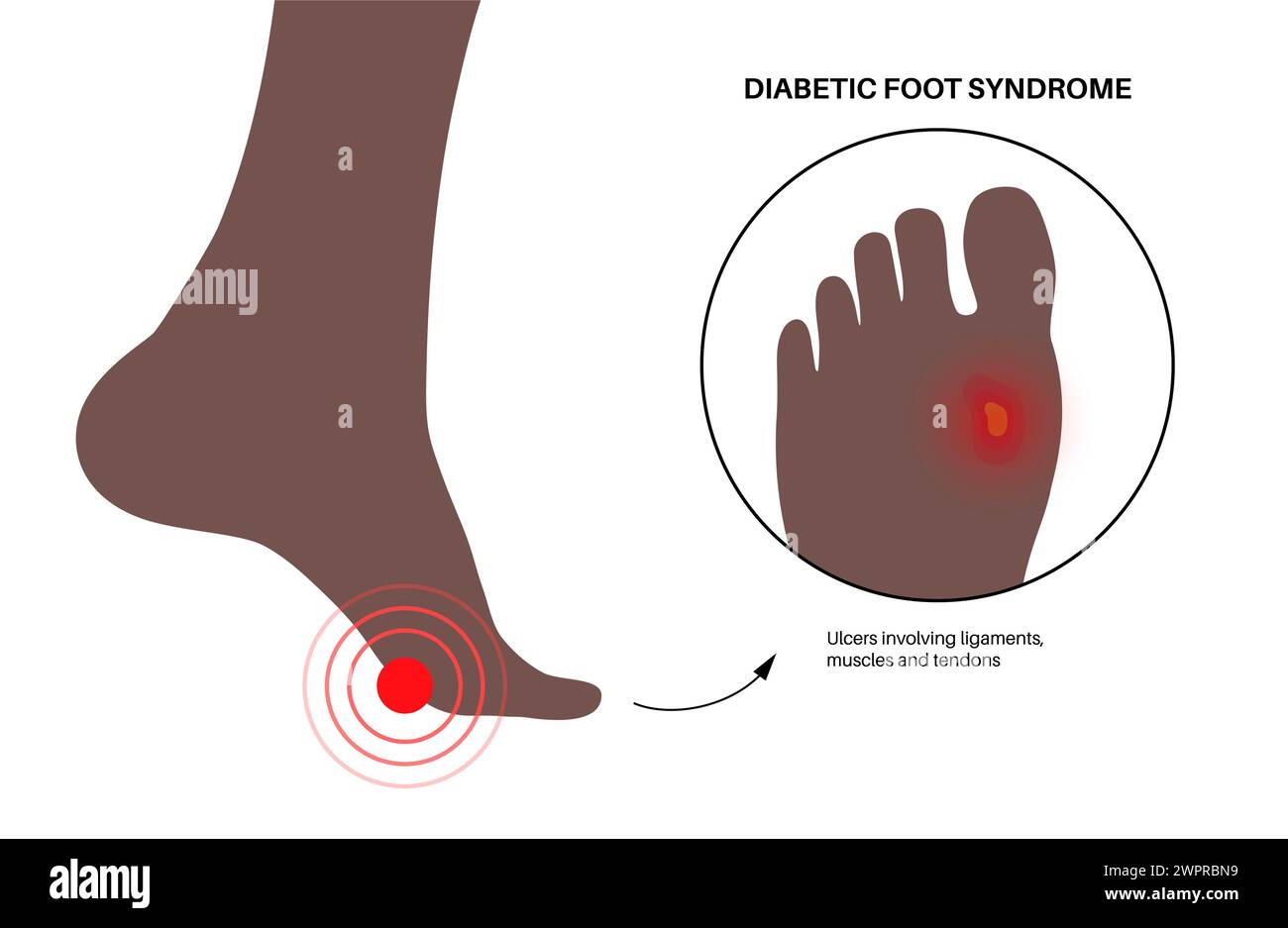 Diabetic foot ulcers, illustration Stock Photo - Alamy