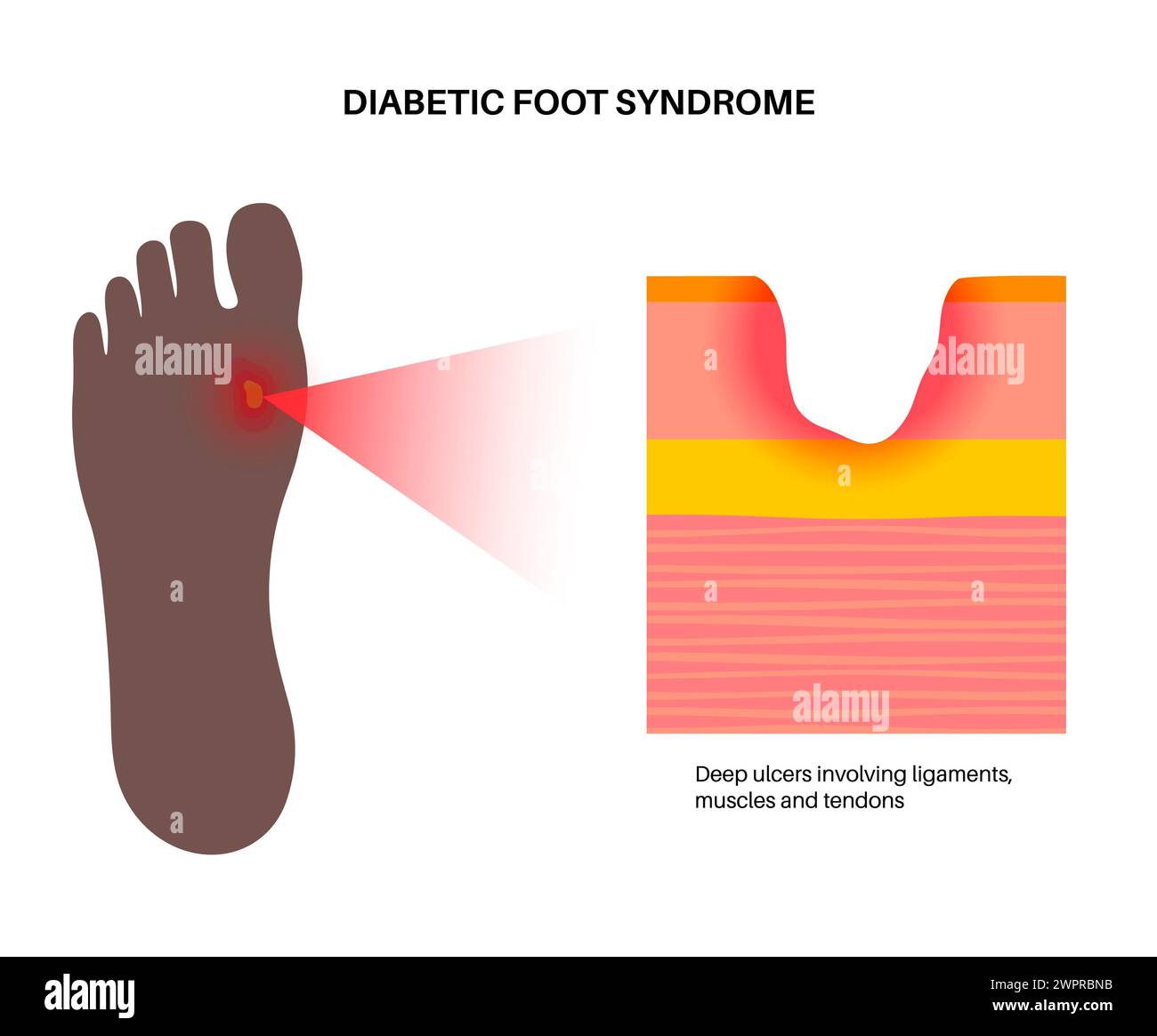 Diabetic foot ulcers, illustration Stock Photo - Alamy