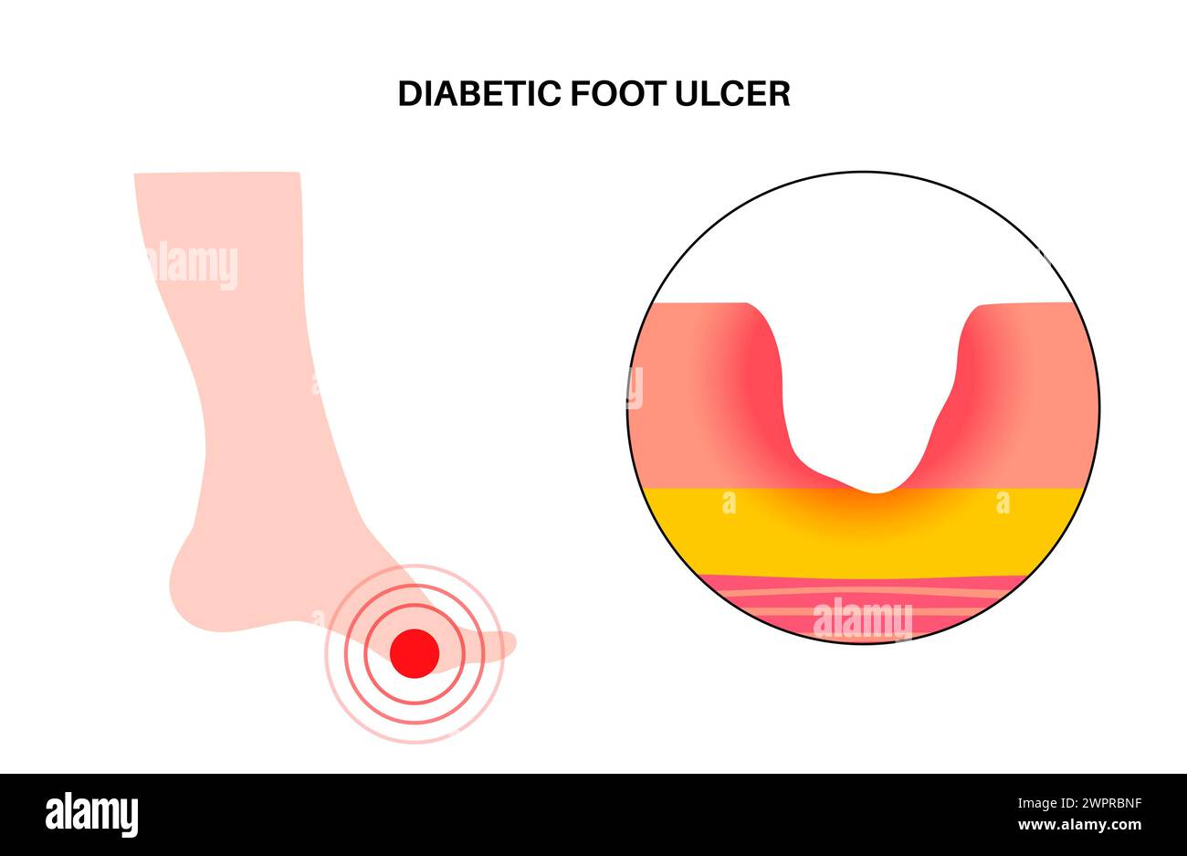 Diabetic foot ulcers, illustration Stock Photo - Alamy