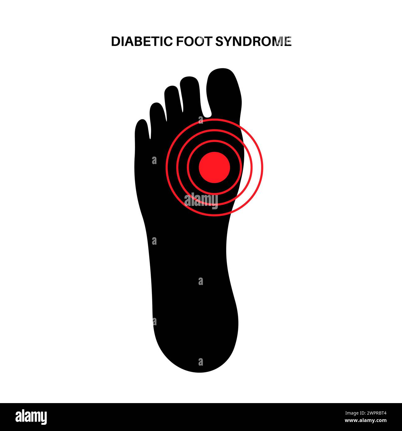 Diabetic foot ulcers, illustration Stock Photo - Alamy