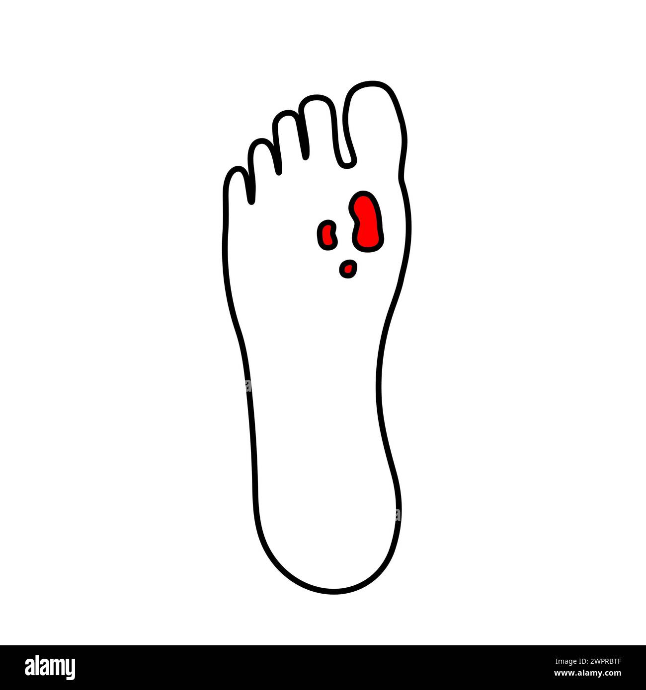 Diabetic foot ulcers, illustration Stock Photo - Alamy