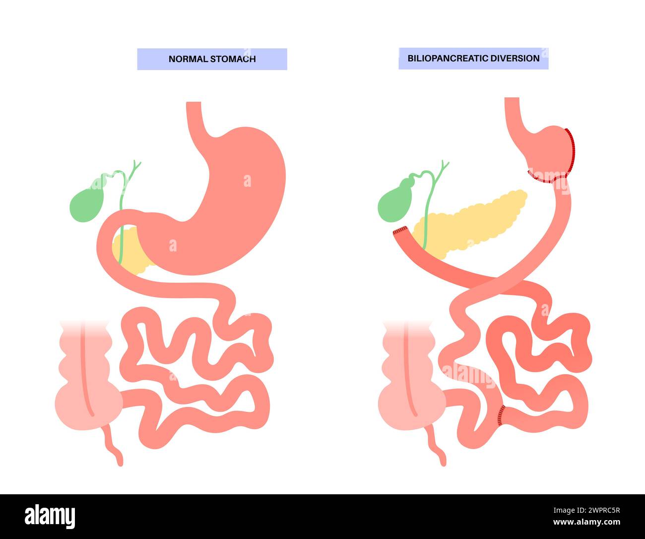 Biliopancreatic diversion procedure, illustration Stock Photo - Alamy