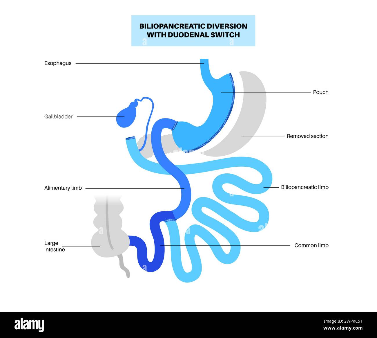 Biliopancreatic diversion procedure, illustration Stock Photo - Alamy