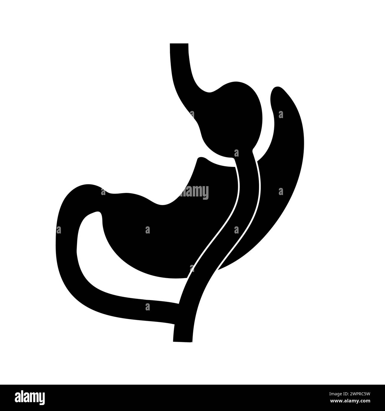 Gastric bypass surgery, illustration Stock Photo - Alamy Gastric bypass surgery, illustration Stock Photo - Alamy