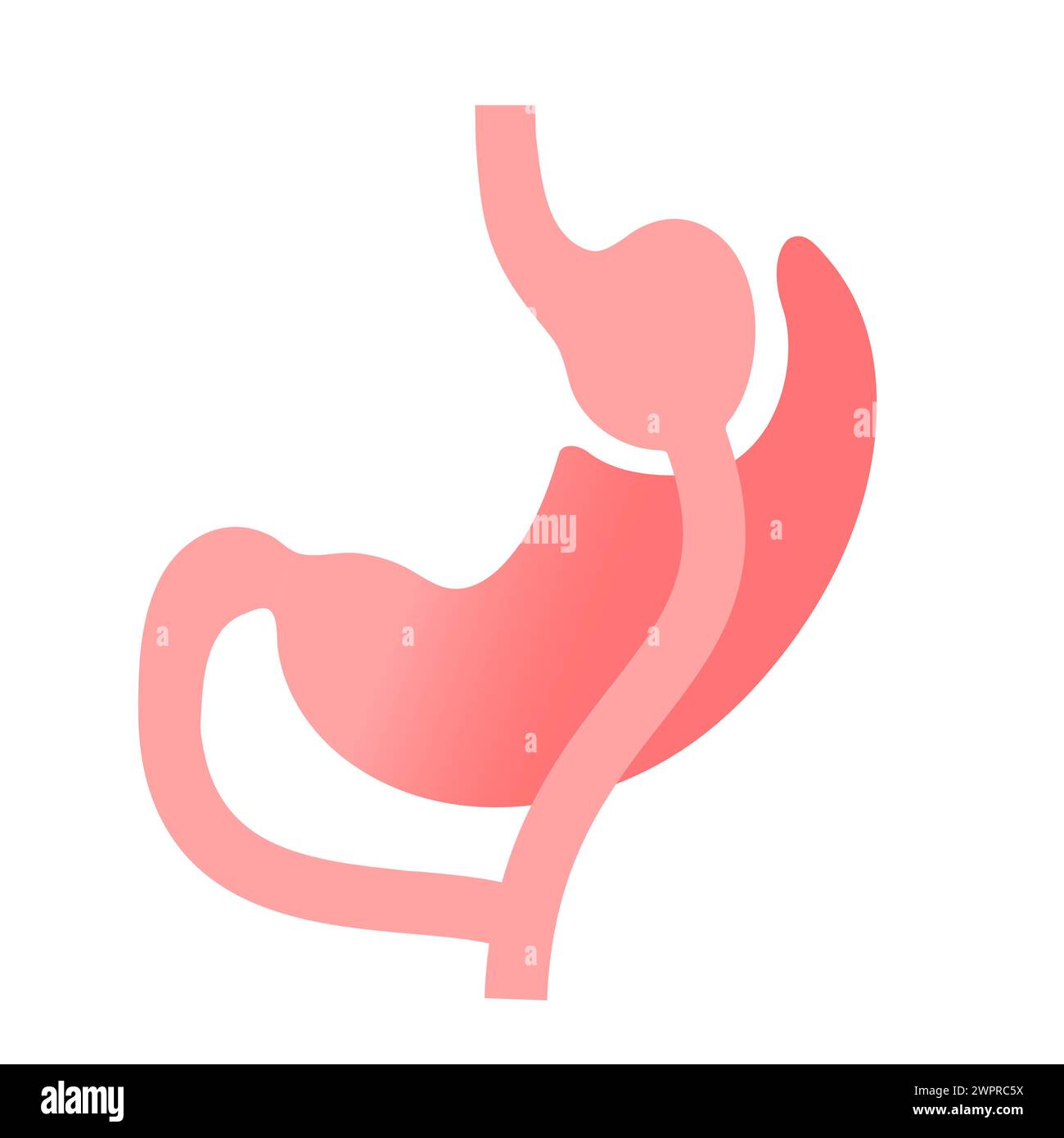 Gastric bypass surgery, illustration Stock Photo - Alamy