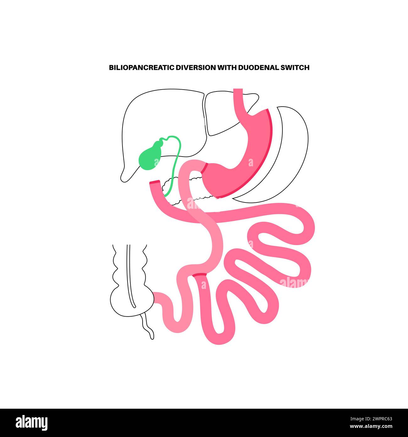 Gastrectomy illustration Cut Out Stock Images & Pictures - Alamy