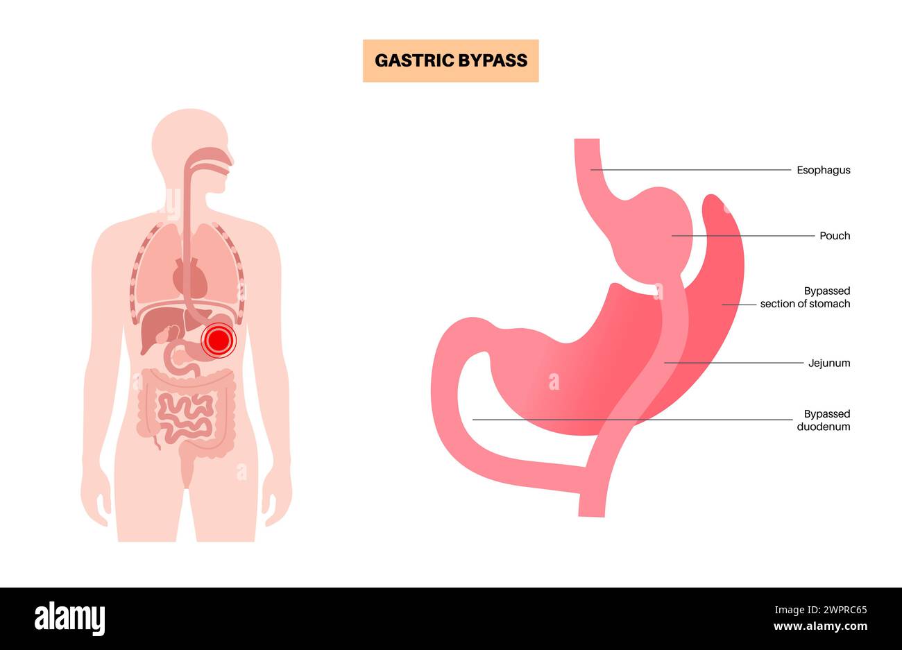 Gastric bypass surgery, illustration Stock Photo - Alamy