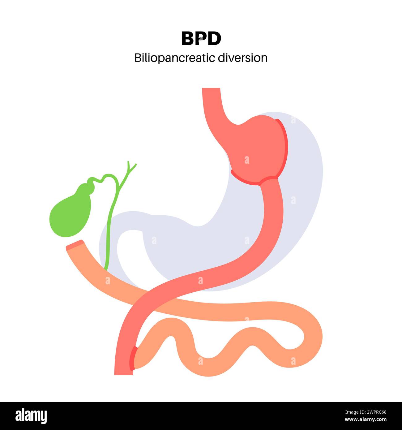 Biliopancreatic diversion procedure, illustration Stock Photo - Alamy